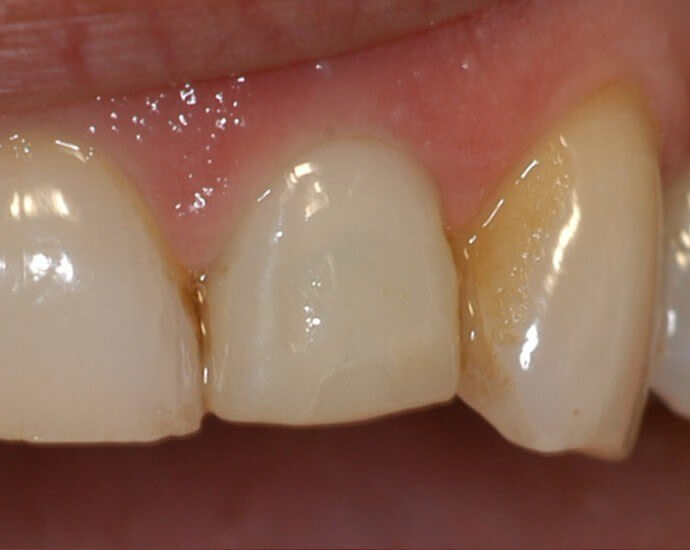 SMILE Technique Dental Implants | NYC Periodontist Near Me