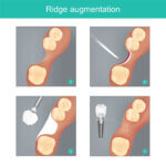 Why Would I Need A Dental Bone Graft Or Ridge Augmentation?