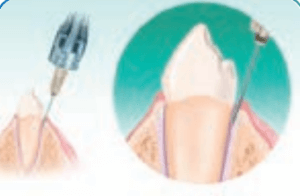 Painless Dental Anesthesia Injections with The Wand